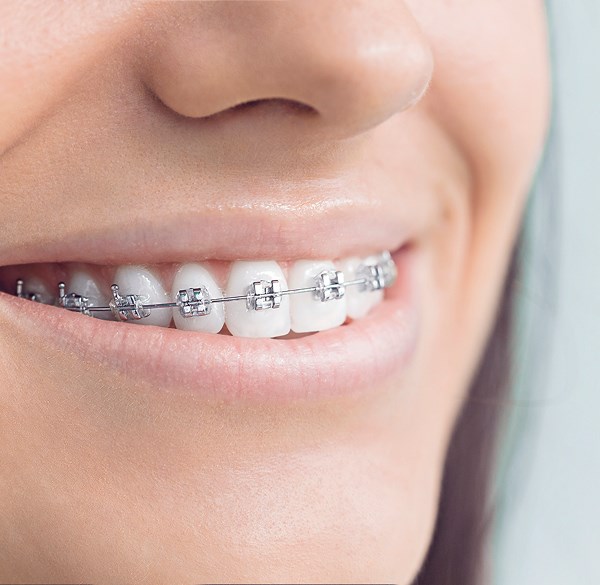 Types of Braces | Phelan Orthodontics Little Rock